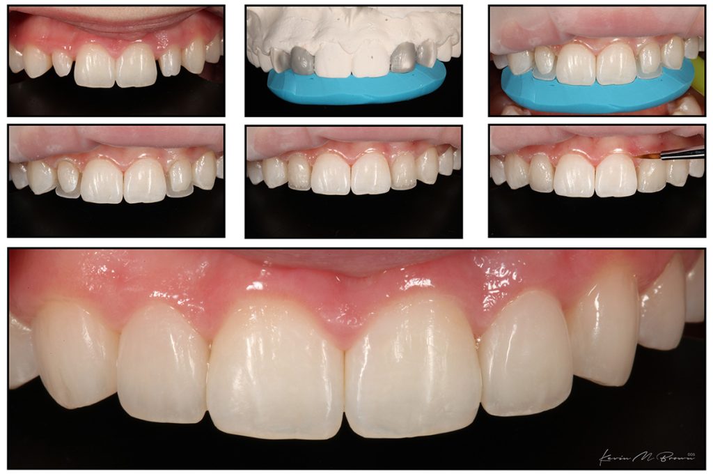 Narrow Teeth | Smile Gallery | Cosmetic Dentists in Bellevue, WA