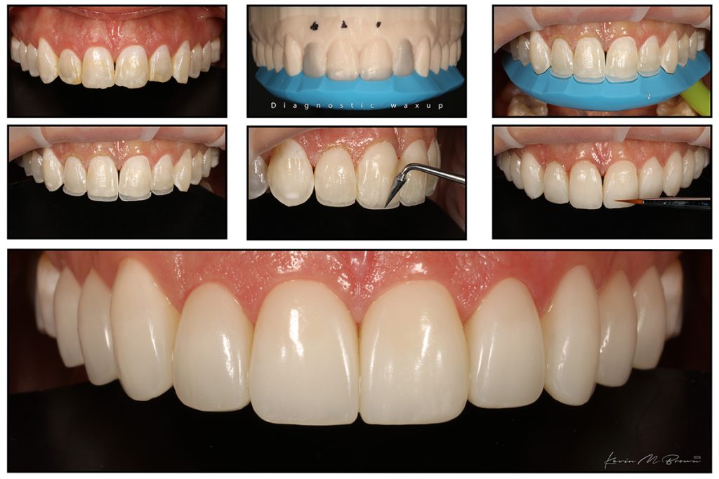 Composite Veneers | Smile Gallery | Cosmetic Dentists in Bellevue, WA